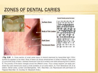 DENTAL CARIES classification, types, treatment and prognosis | PPT