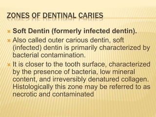 DENTAL CARIES classification, types, treatment and prognosis | PPT