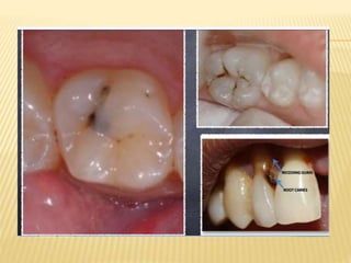 DENTAL CARIES classification, types, treatment and prognosis | PPT