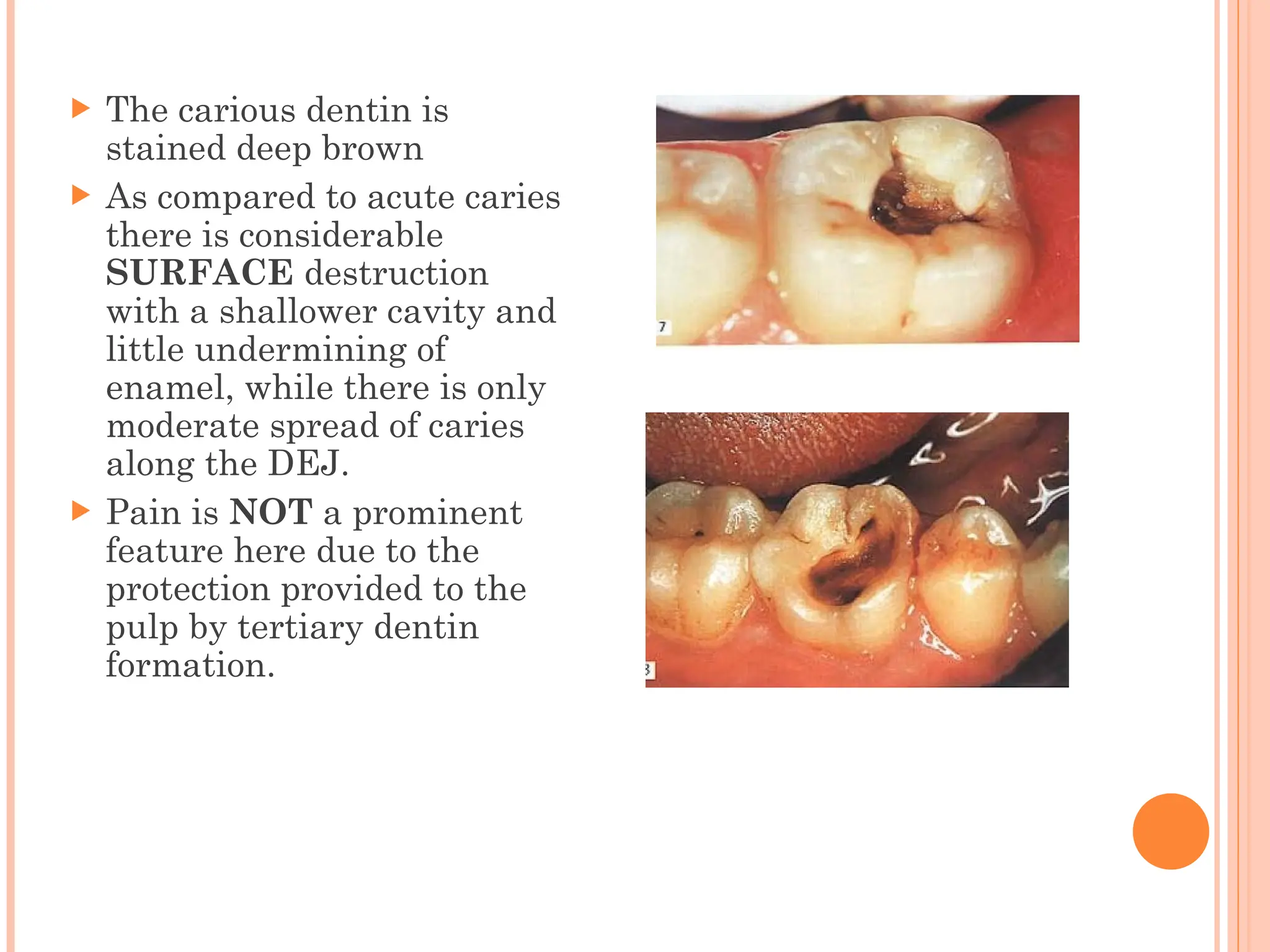 dental caries YS OF COURSE WHY NOTWR.ppt
