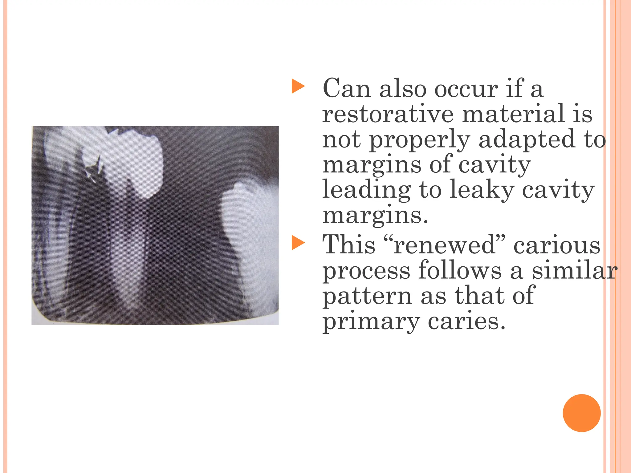 dental caries YS OF COURSE WHY NOTWR.ppt
