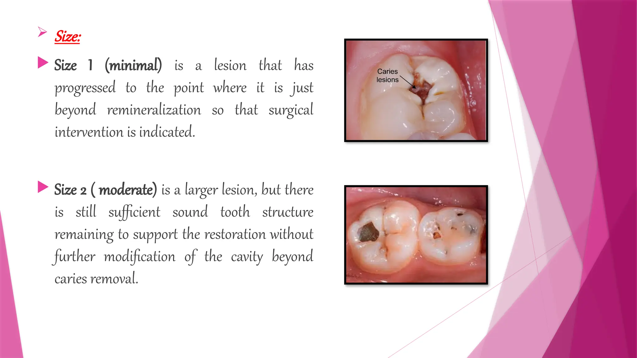 Dental Caries with classification etiology and management | PPT