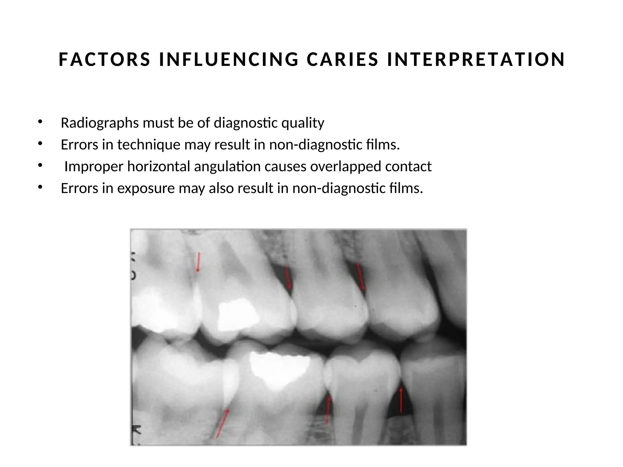 Dental caries.pptx. Dental caries.pptx