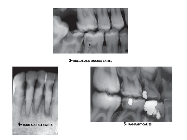 Dental caries.pptx. Dental caries.pptx