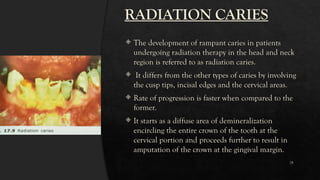 Dental caries ppt of prosthodontics(DMS) | PPTX