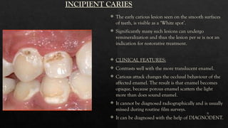 Dental caries ppt of prosthodontics(DMS) | PPTX