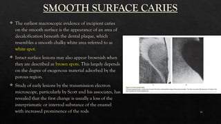 Dental caries ppt of prosthodontics(DMS) | PPTX