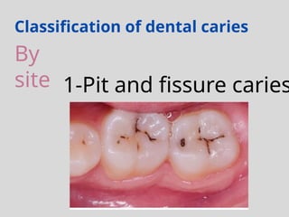 Dental caries in oral cavity oral Pathology Lab ٠.pptx