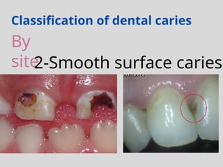 Dental caries in oral cavity oral Pathology Lab ٠.pptx