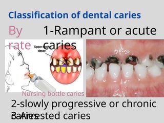 Dental caries in oral cavity oral Pathology Lab ٠.pptx