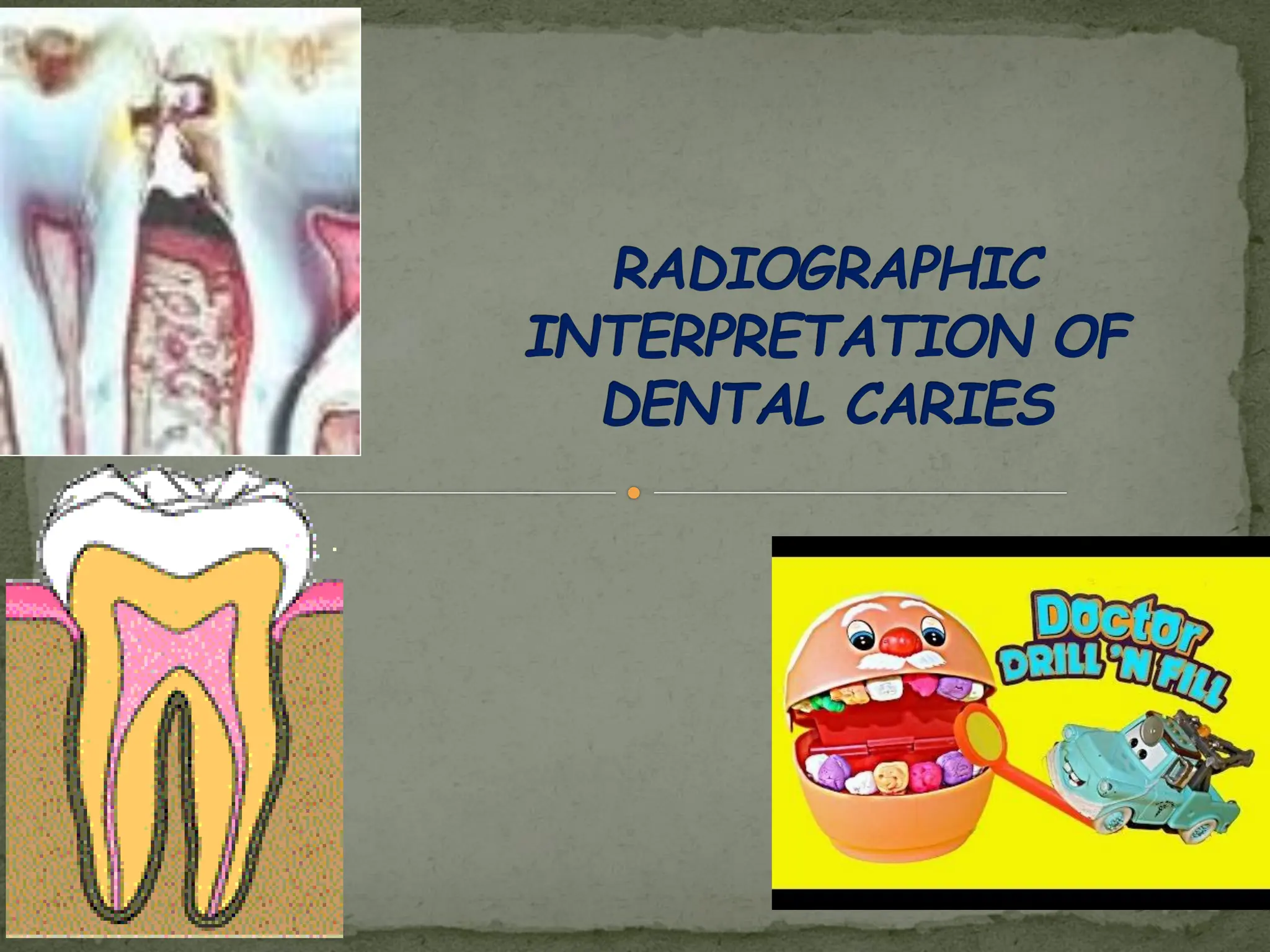 dental caries radiographic presentations | PDF