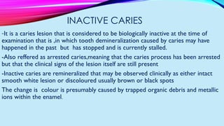 Dental Caries - Introduction, Theoriesss | PPTX