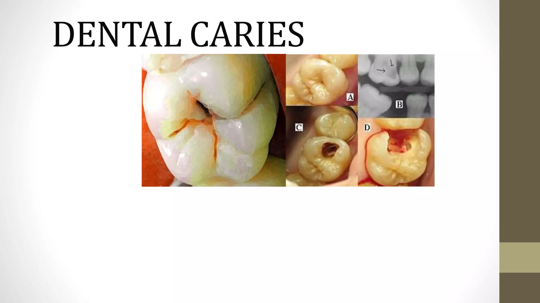 Dental caries- etiology clinical features histopathology and caries ...