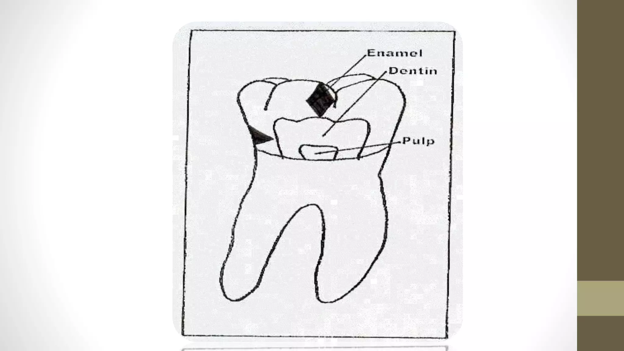 Dental caries- etiology clinical features histopathology and caries ...