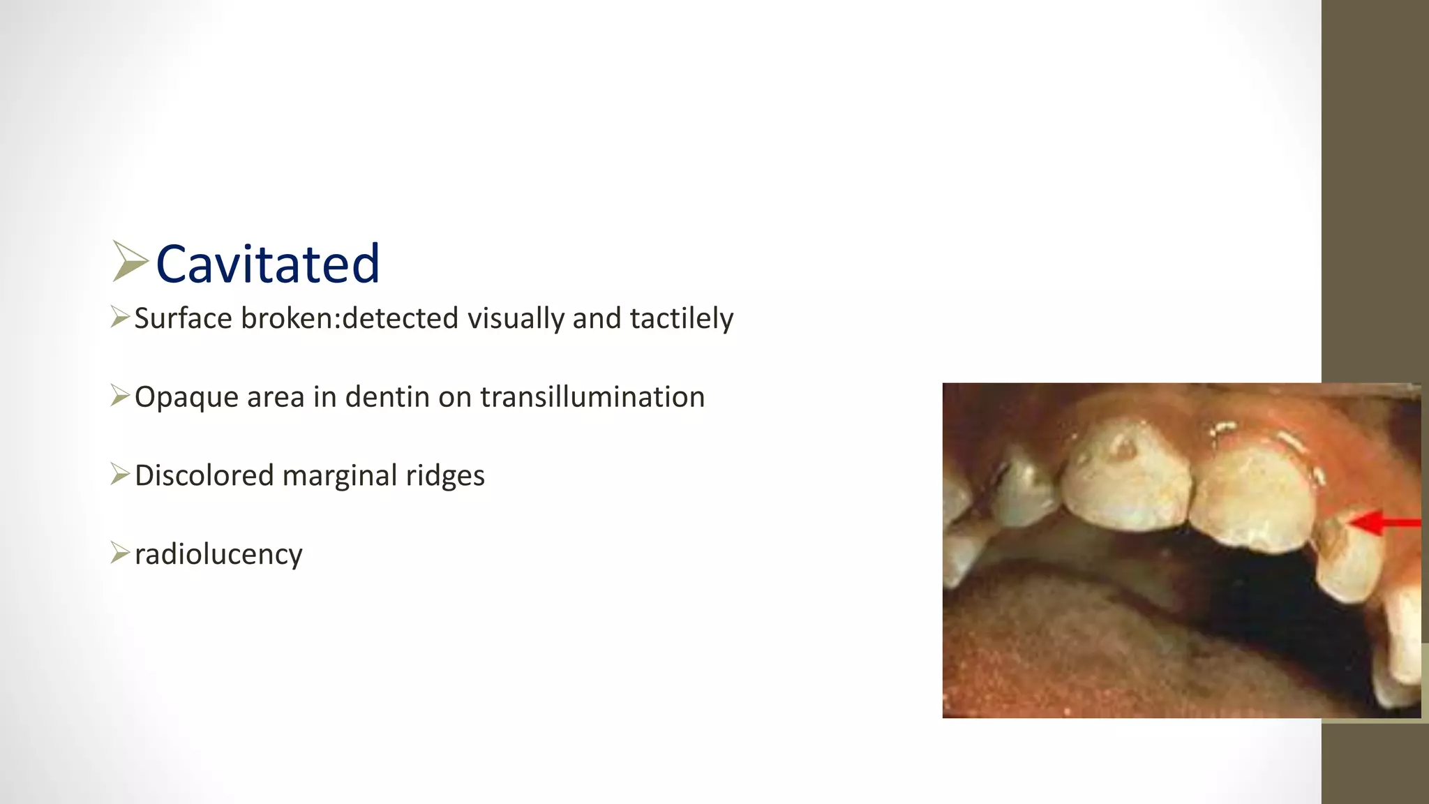 Dental caries- etiology clinical features histopathology and caries ...