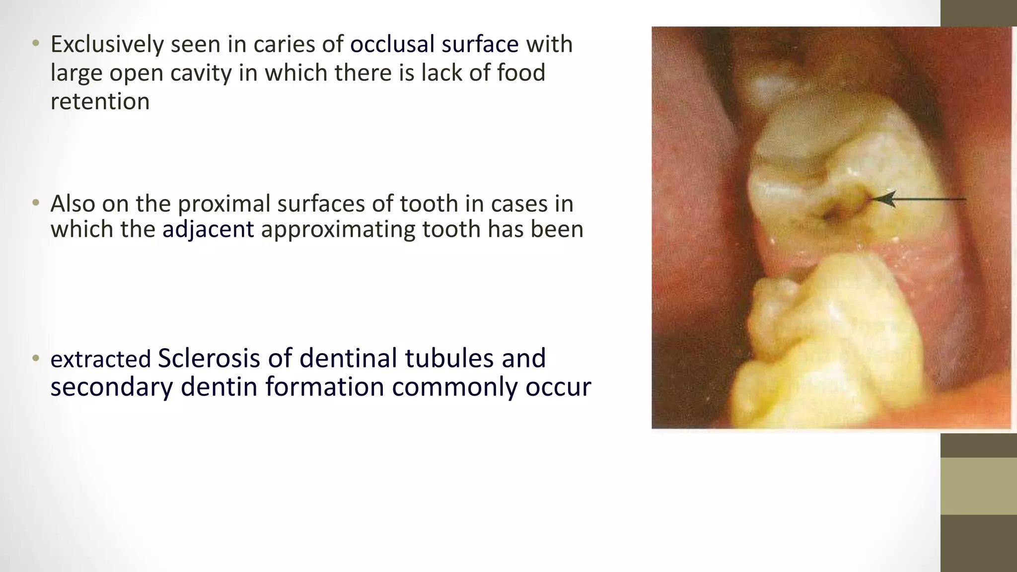 Dental caries- etiology clinical features histopathology and caries ...