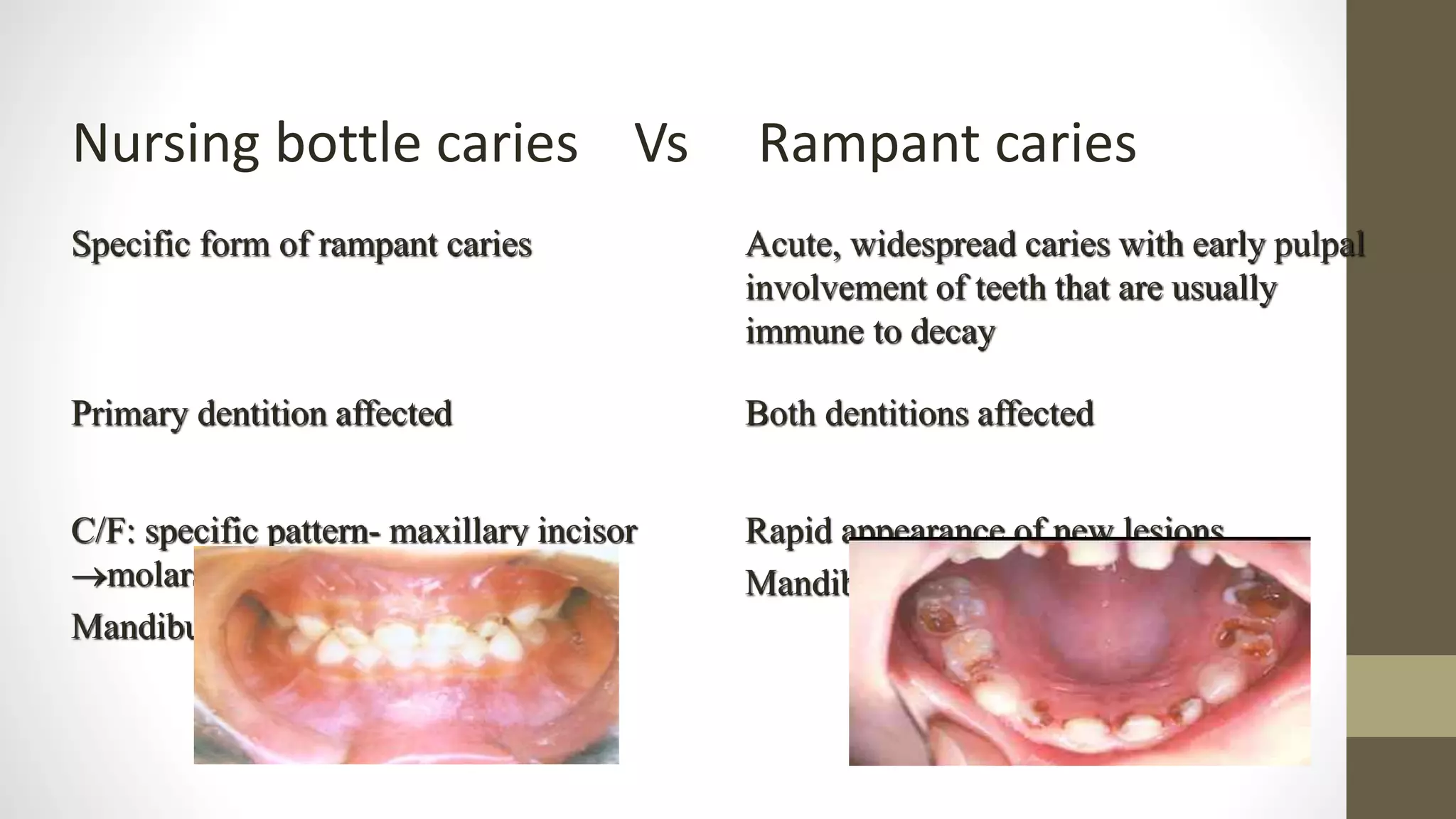 Dental caries- etiology clinical features histopathology and caries ...