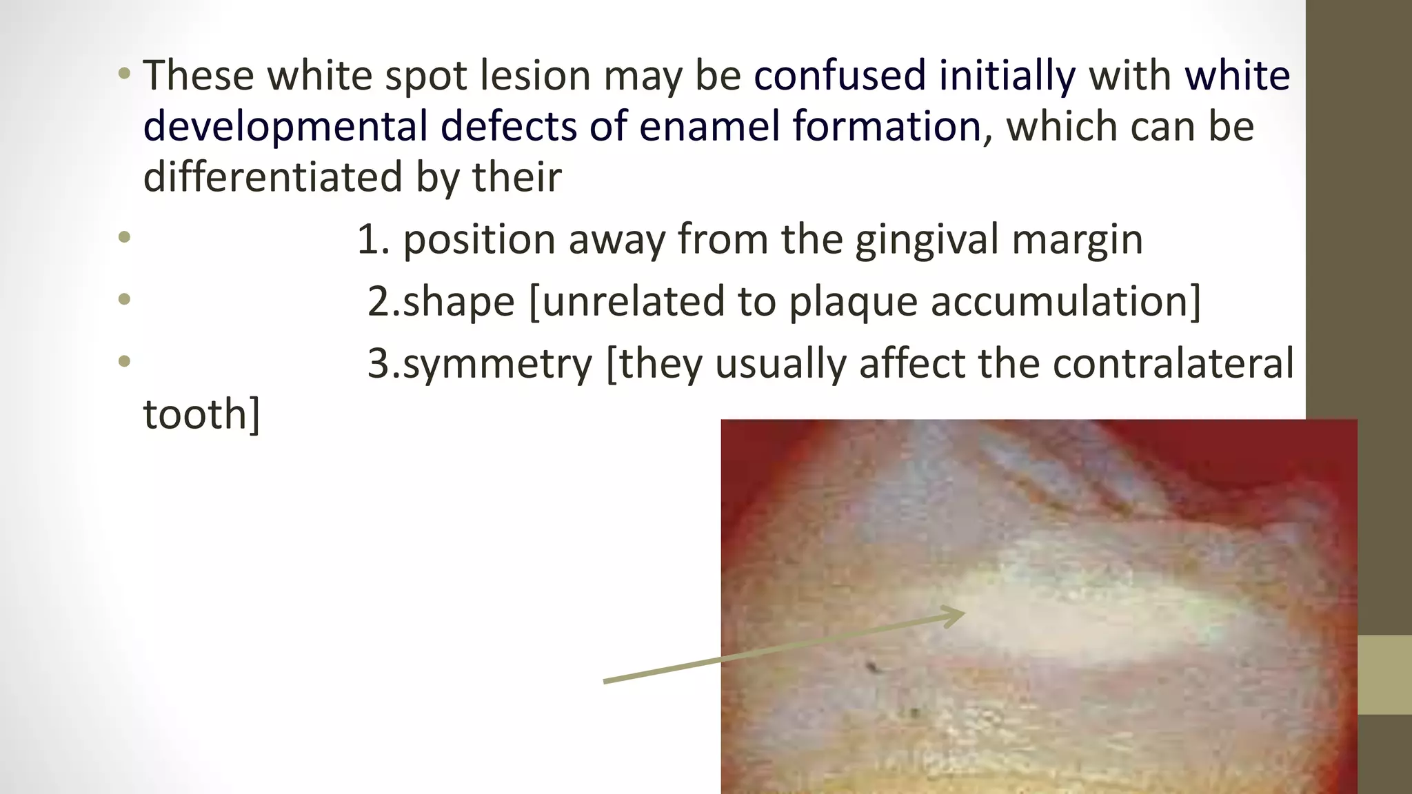 Dental caries- etiology clinical features histopathology and caries ...