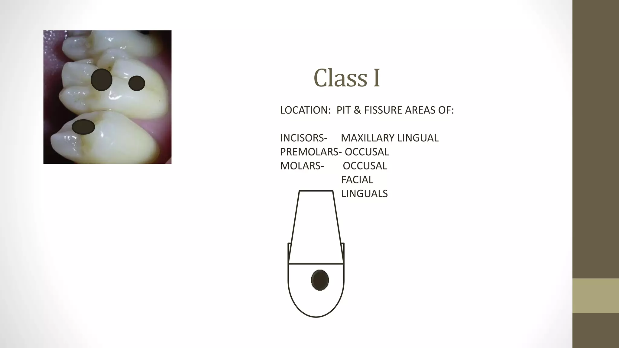 Dental caries- etiology clinical features histopathology and caries ...