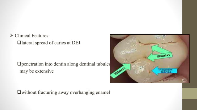 Dental caries- etiology clinical features histopathology and caries ...