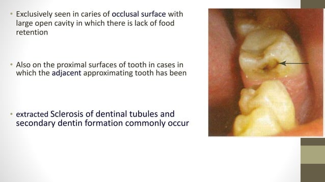 Dental caries- etiology clinical features histopathology and caries ...