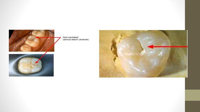 Dental caries- etiology clinical features histopathology and caries ...