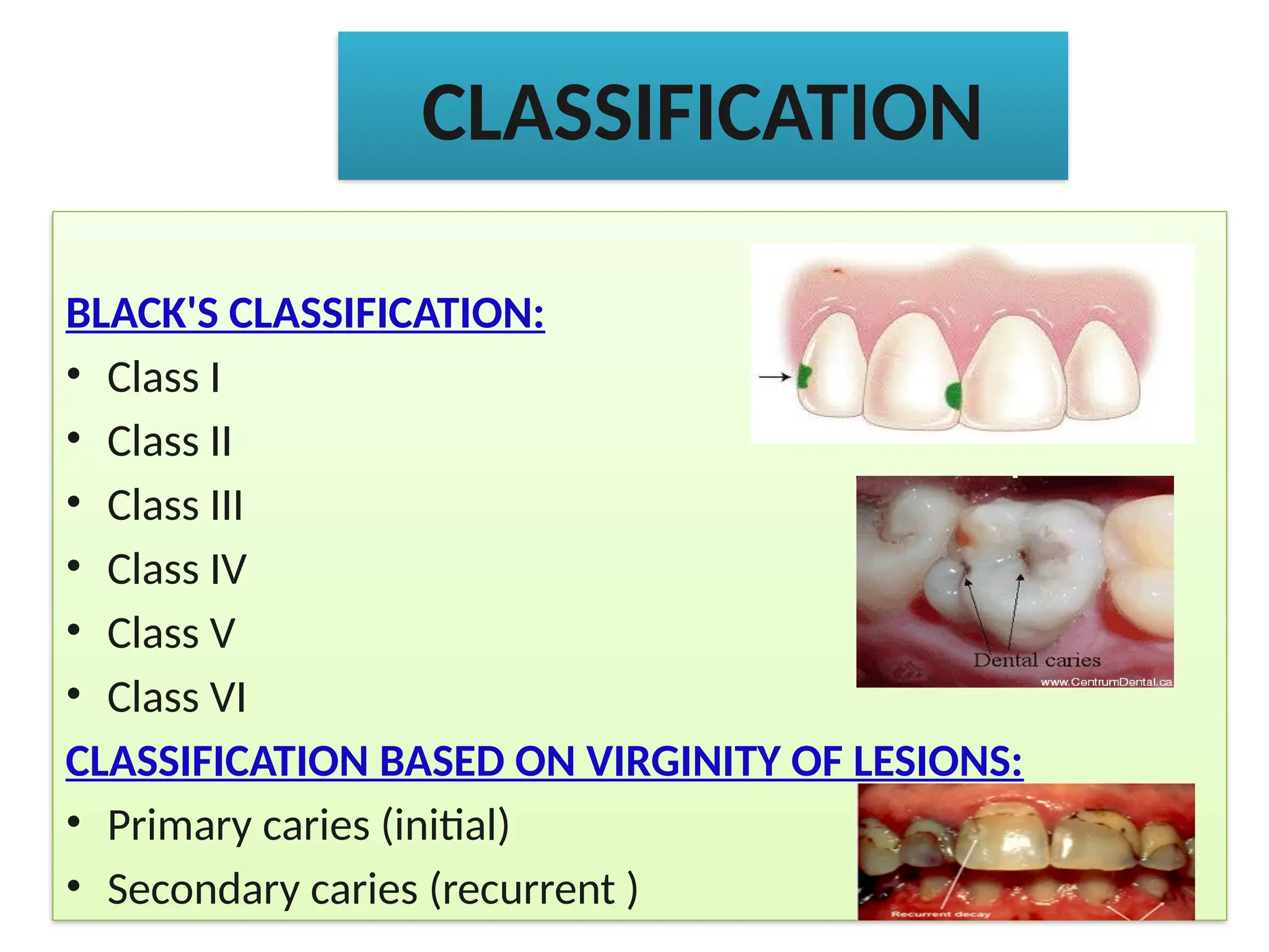 DENTAL CARIES - Classification And Theories.pptx