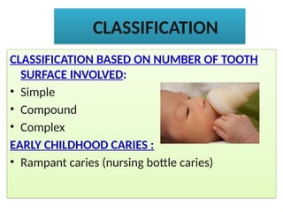 DENTAL CARIES - Classification And Theories.pptx