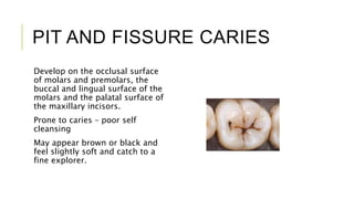 Dental caries | PPT