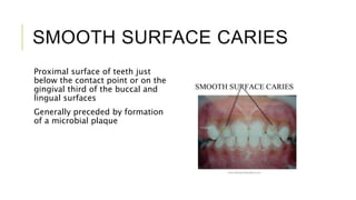 Dental caries | PPT