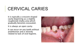 Dental caries | PPT