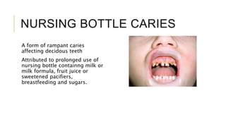 Dental caries | PPTX
