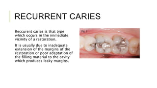 Recurrent Caries