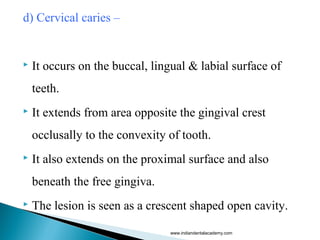 Dental caries 2/cosmetic dentistry courses | PPT
