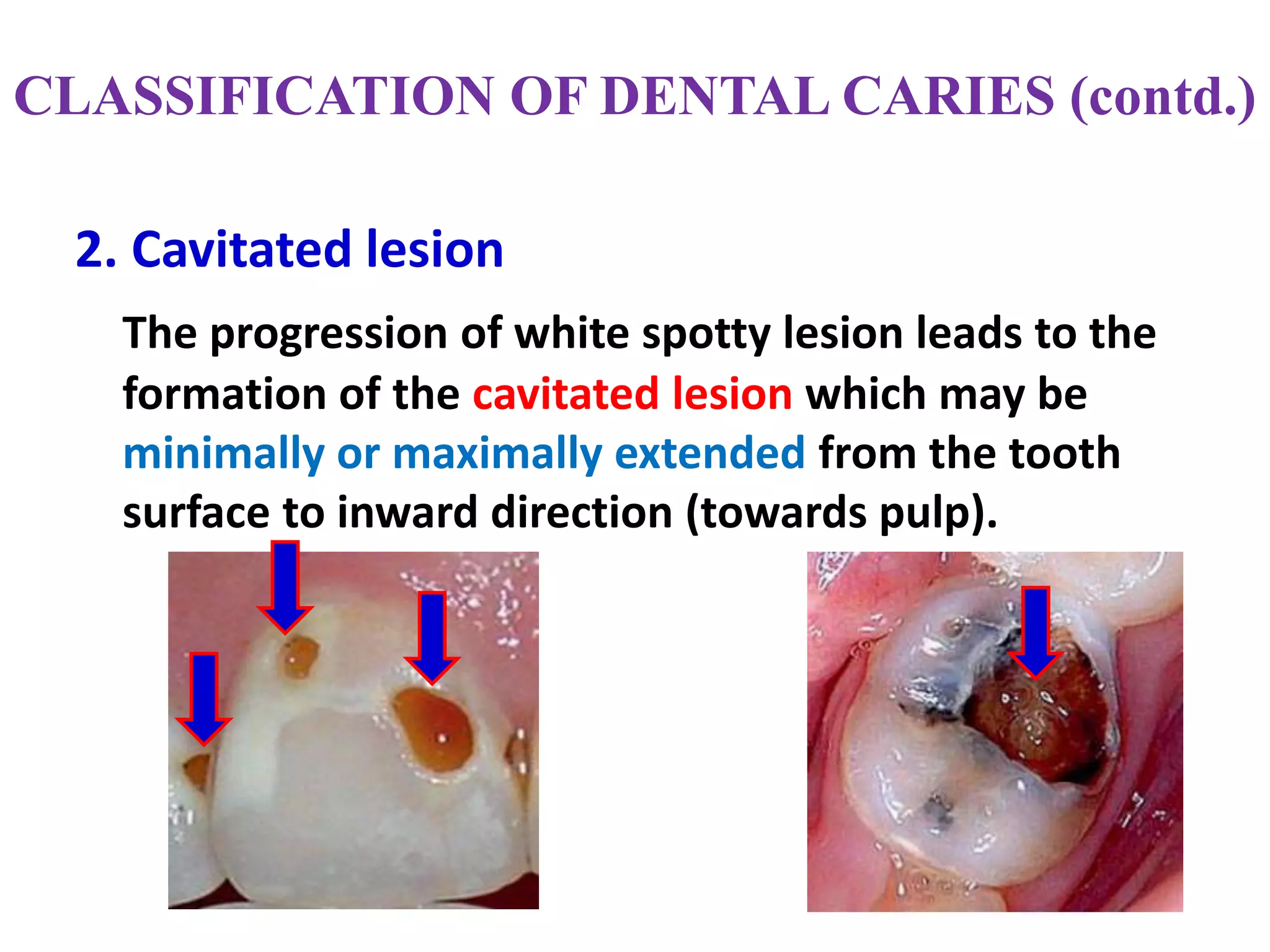 Dental Caries | PPTX