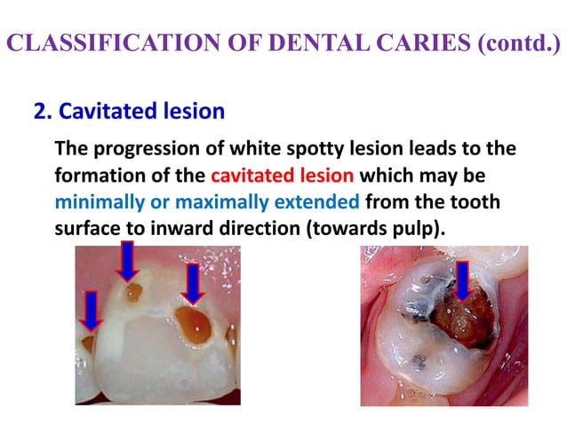 Dental Caries | PPTX | Dental Health | Diseases and Conditions