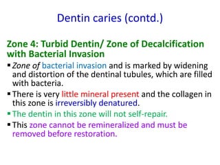 Dental Caries | PPT