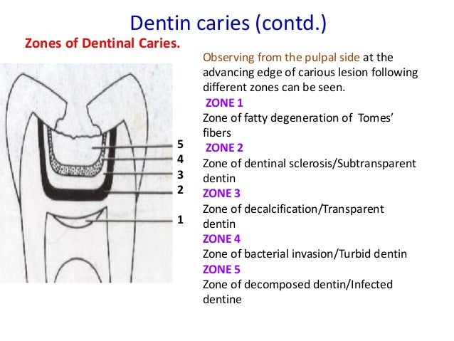 Dental Caries