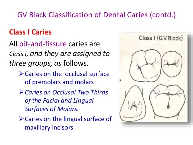 Dental Caries Classification