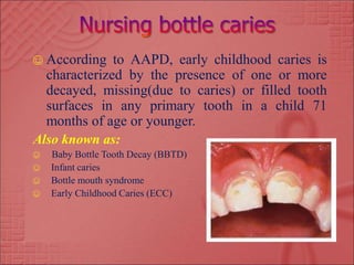 DENTAL CARIES PPT | PPT
