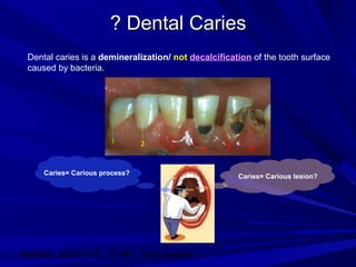 Dental caries22 | PPT