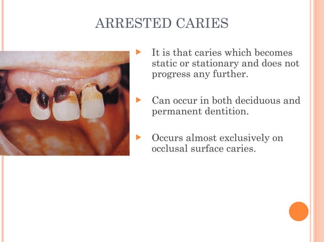 dental caries PRESENTATION DOWNLOAD FREE.ppt