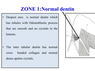 Dental caries 5/certified fixed orthodontic courses by Indian dental ...