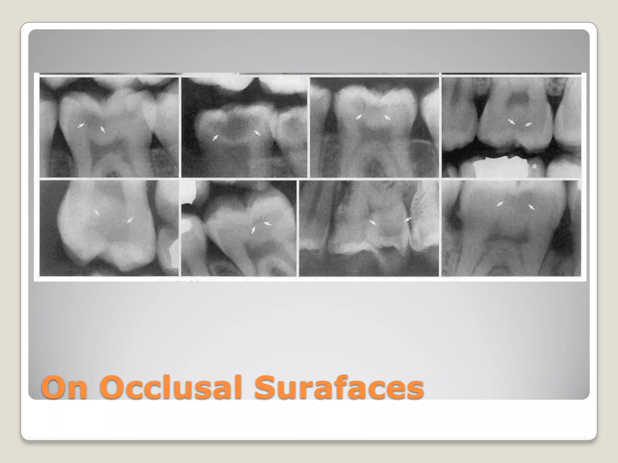 Dental caries and anomalies in radiograph | PDF