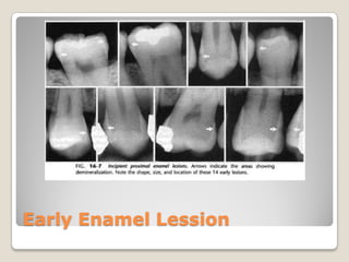 Dental caries and anomalies in radiograph | PDF