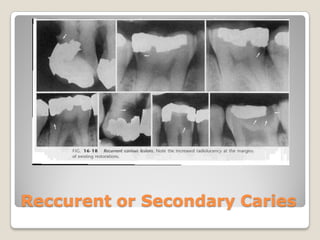 Dental caries and anomalies in radiograph | PDF