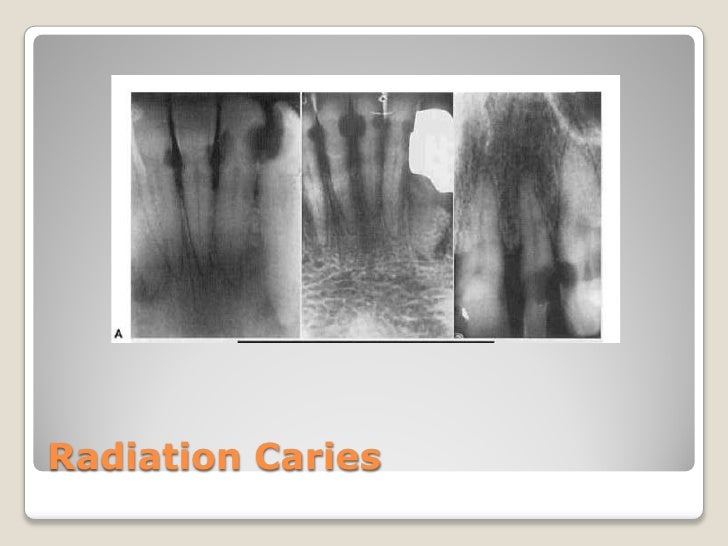 Rampant Caries Radiograph