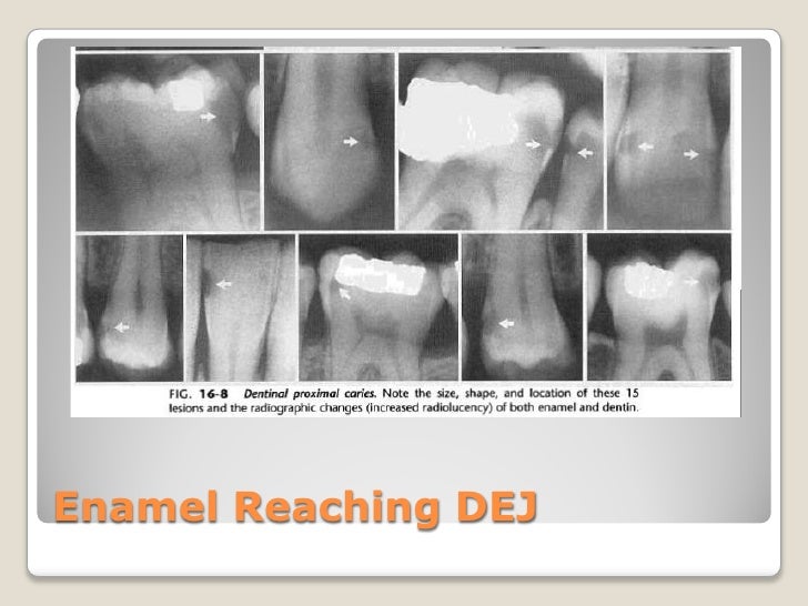 Dental caries and anomalies in radiograph
