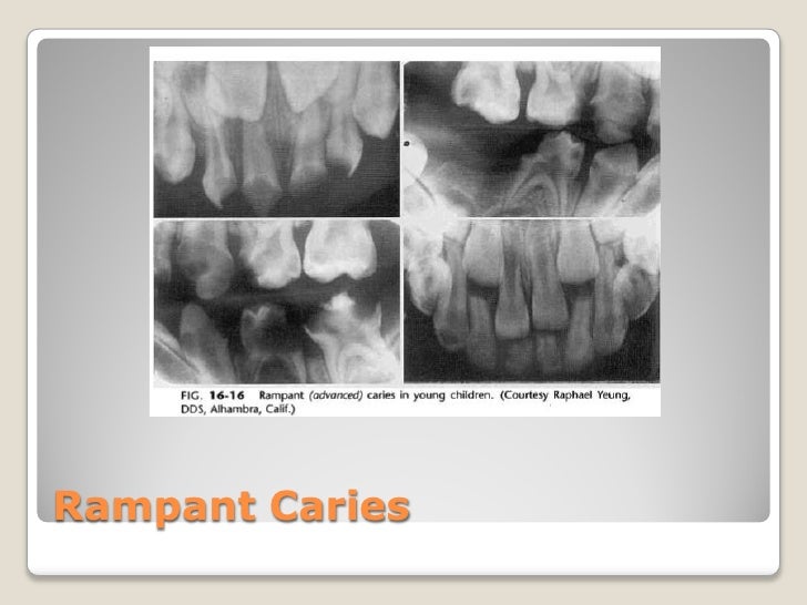 Rampant Caries Radiograph