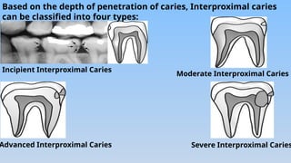 Dental caries and radiographic assessment of restoration.pptx